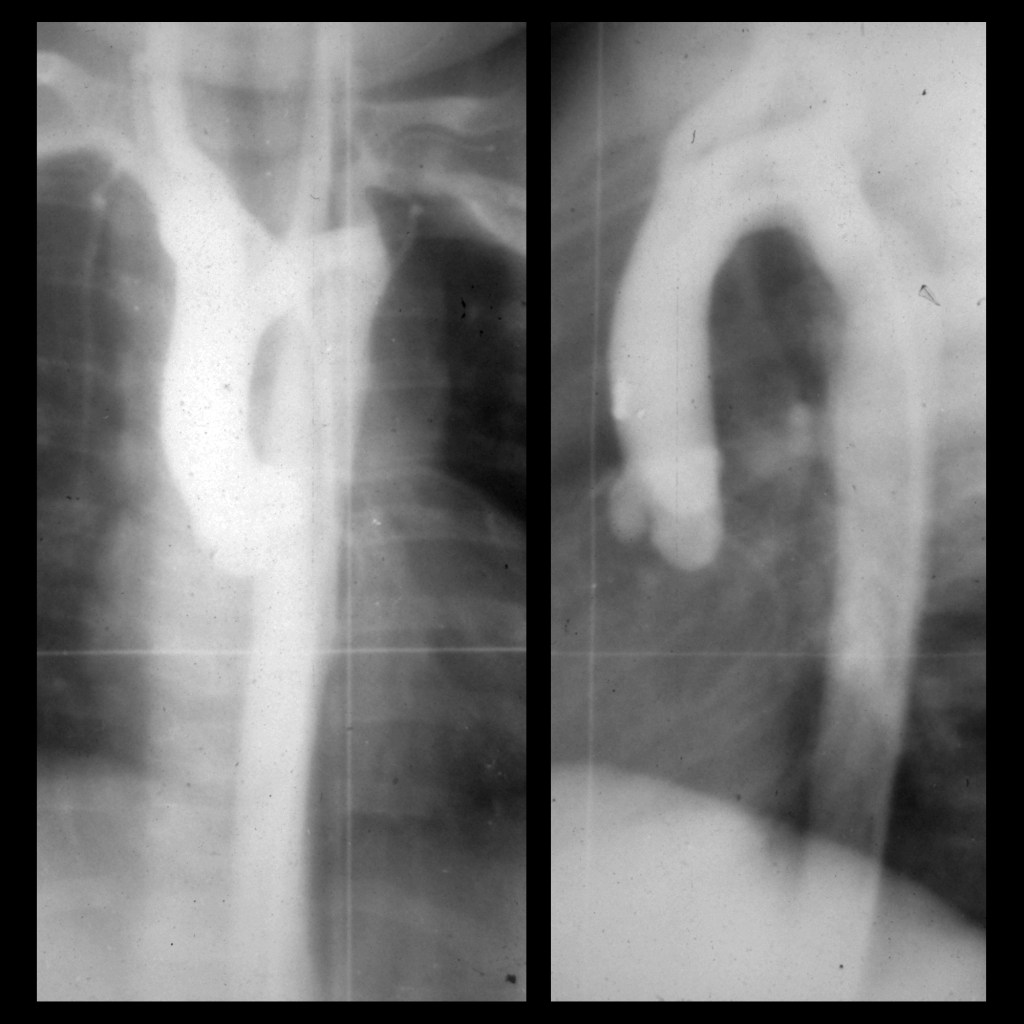 Pediatric Double Aortic Arch | Pediatric Radiology Reference Article ...
