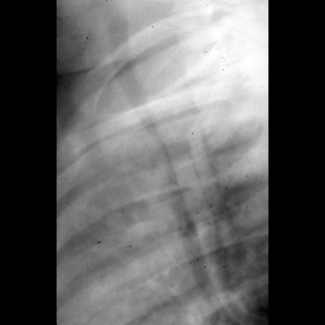 Toddler with stridor | Pediatric Radiology Case | Pediatric Imaging ...