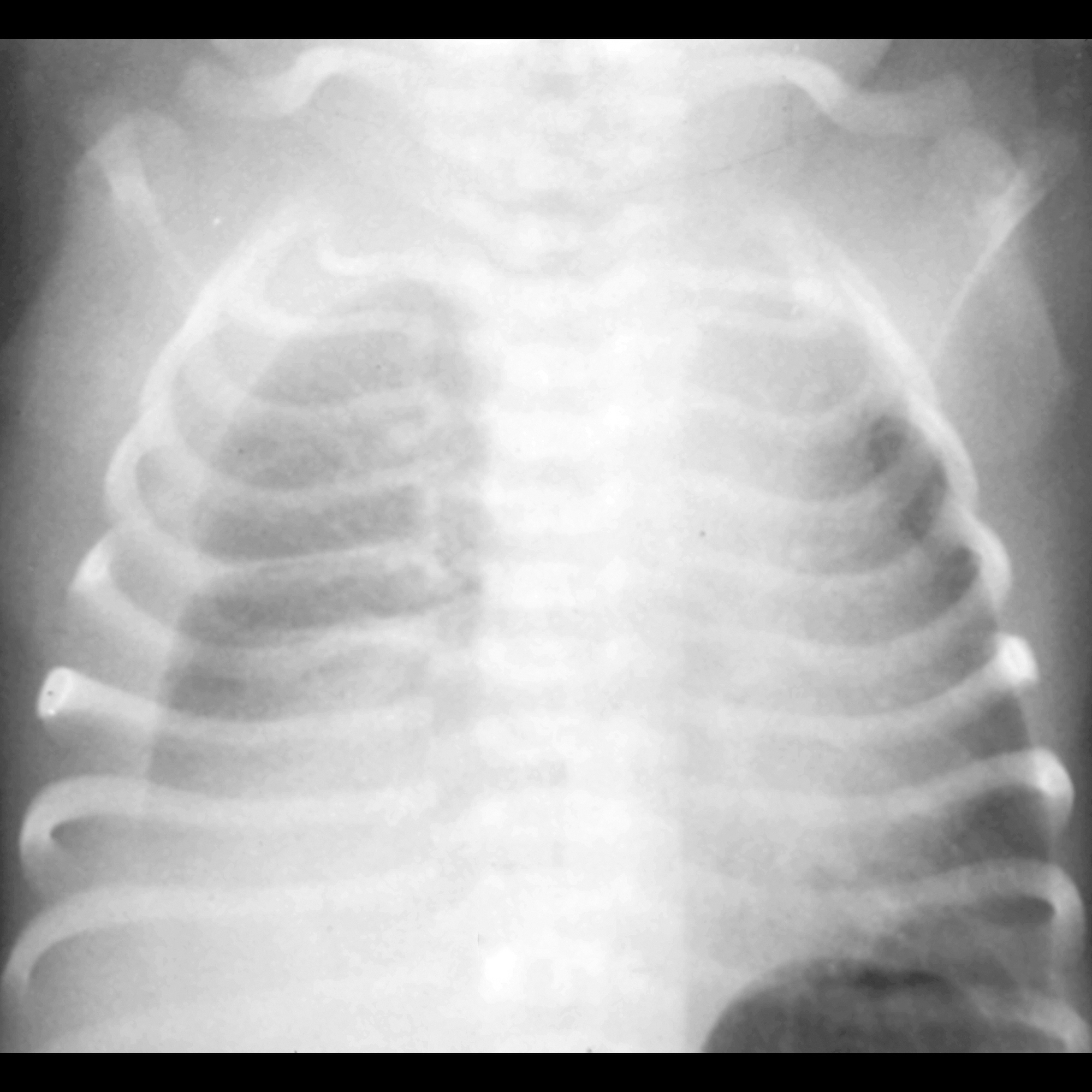Pediatric Chylothorax | Pediatric Radiology Reference Article ...