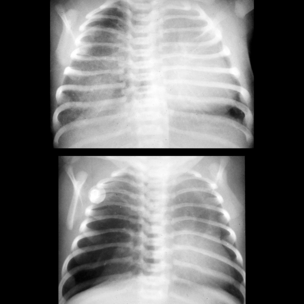 Congenital Lobar Emphysema | Pediatric Radiology Reference Article ...