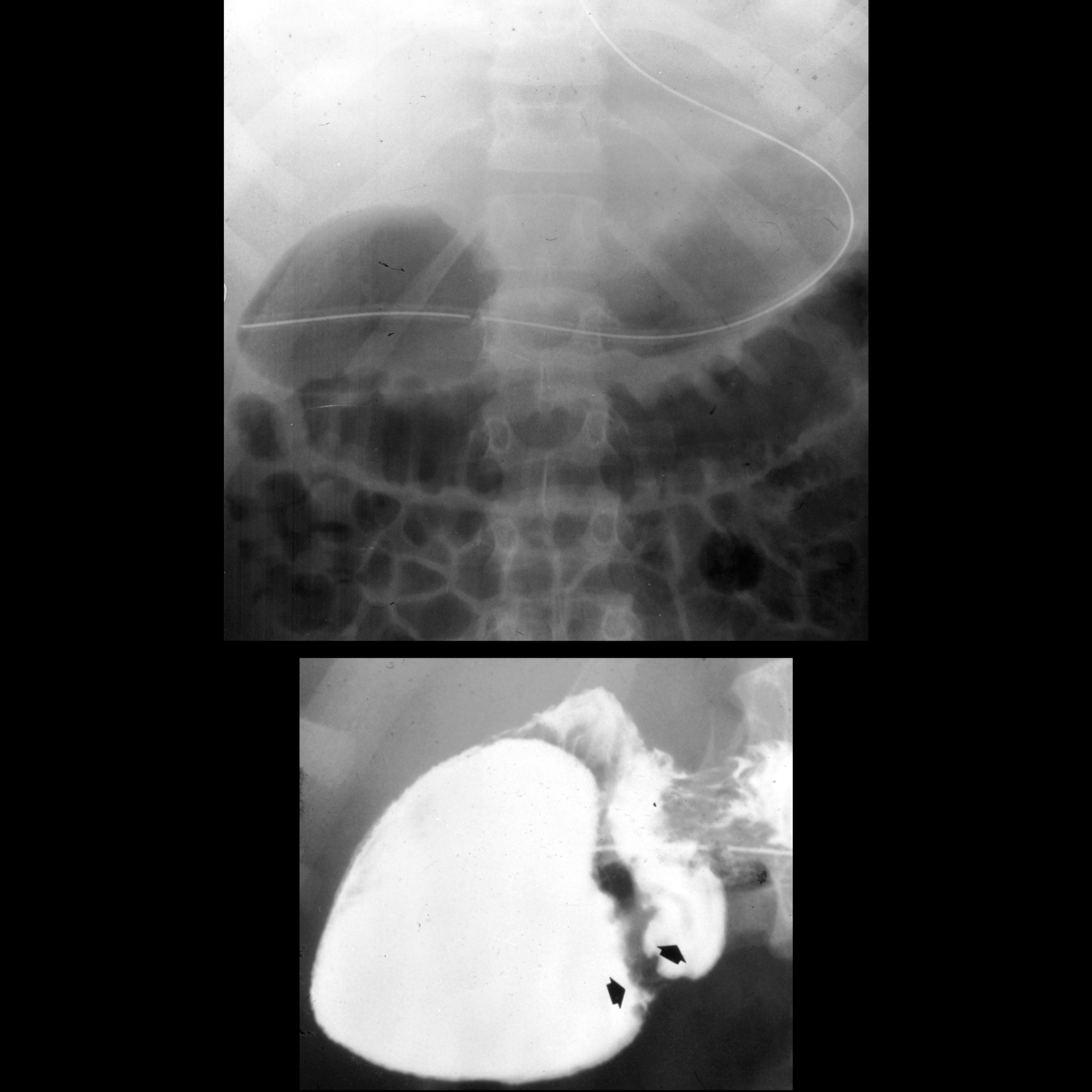 Pediatric Duodenal Stenosis | Pediatric Radiology Reference Article ...
