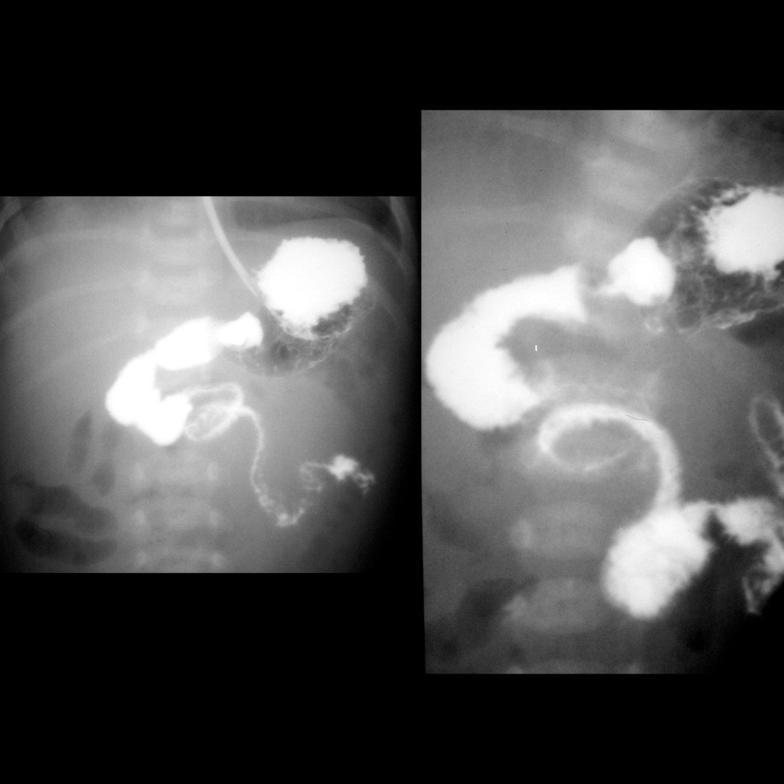 Malrotation With Midgut Volvulus | Pediatric Radiology Reference ...