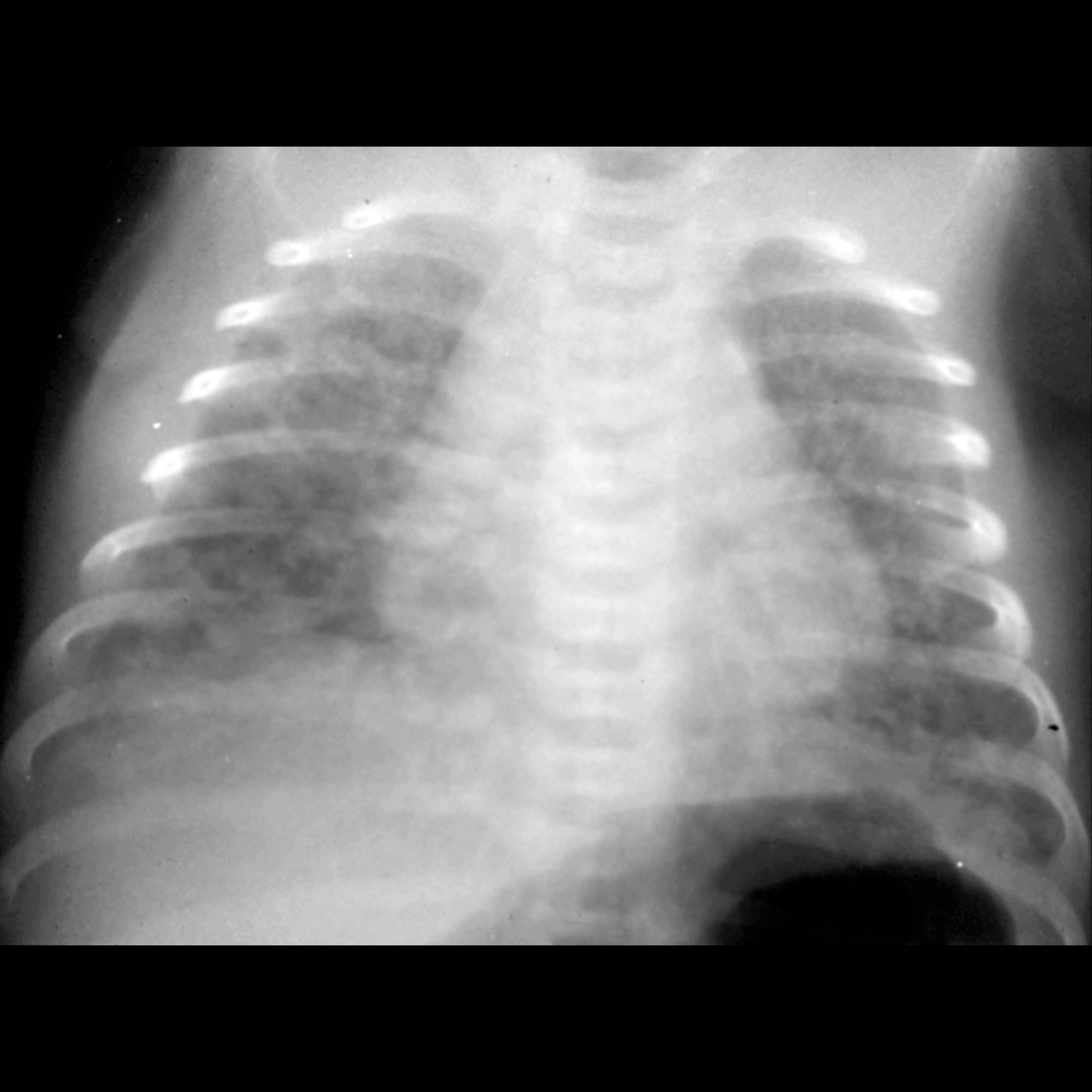 Meconium Aspiration Syndrome Meconium Stained Amniotic Fluid