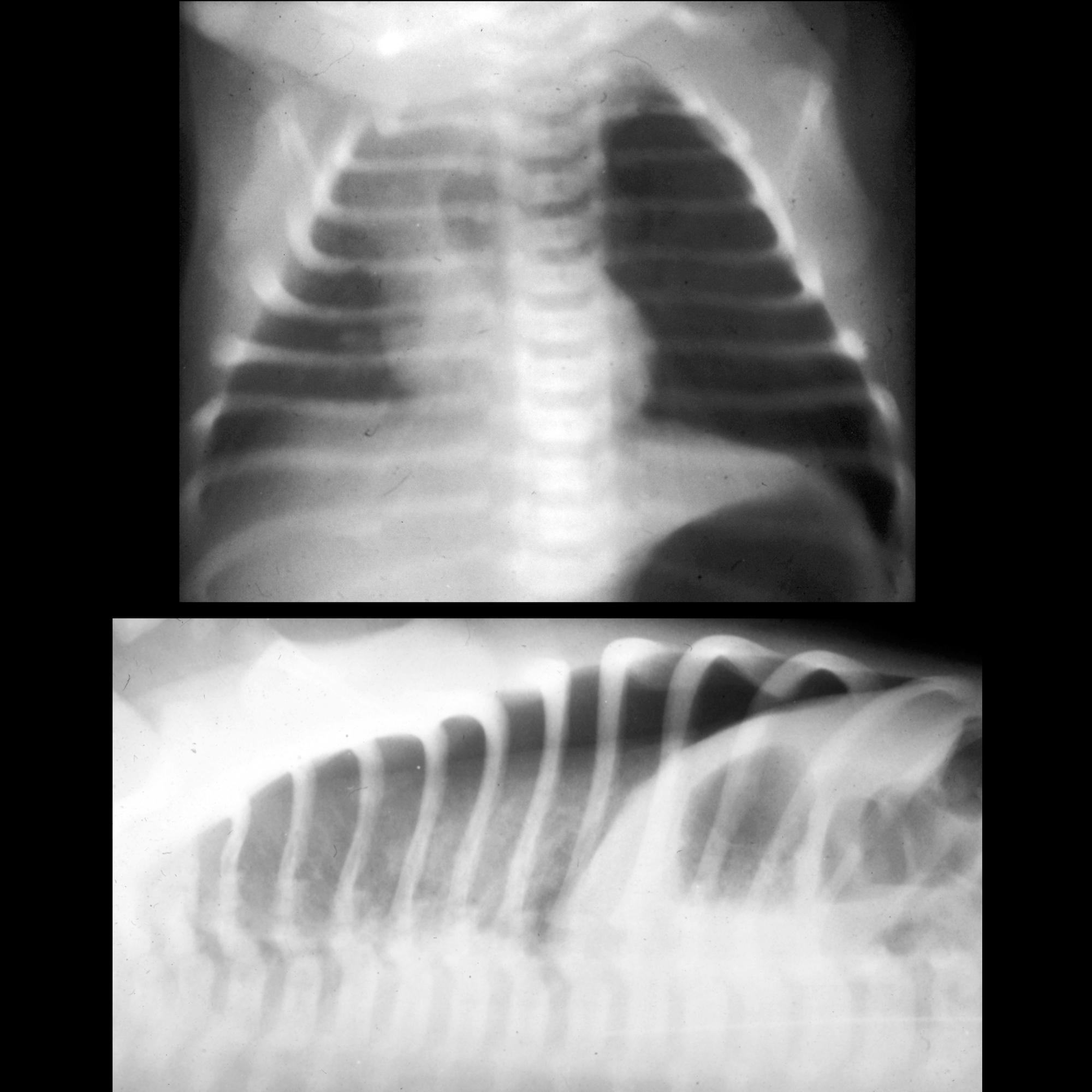 Pediatric Pneumothorax | Pediatric Radiology Reference Article ...