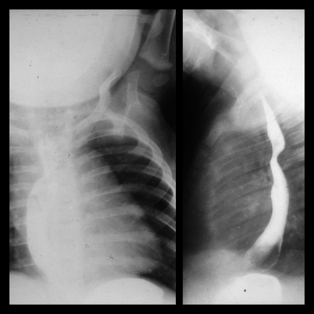Infant with dysphagia | Pediatric Radiology Case | Pediatric Imaging ...
