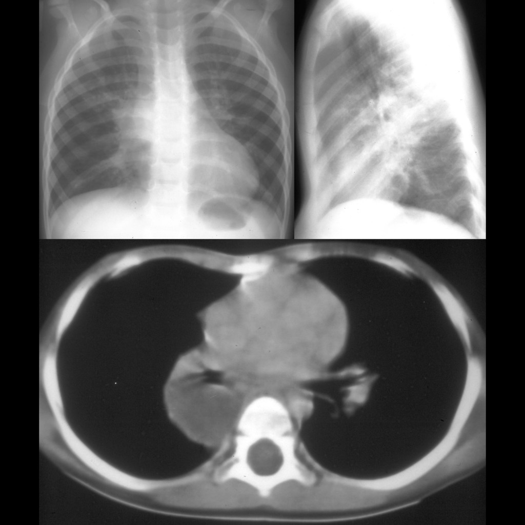 Esophageal Duplication | Pediatric Radiology Reference Article ...