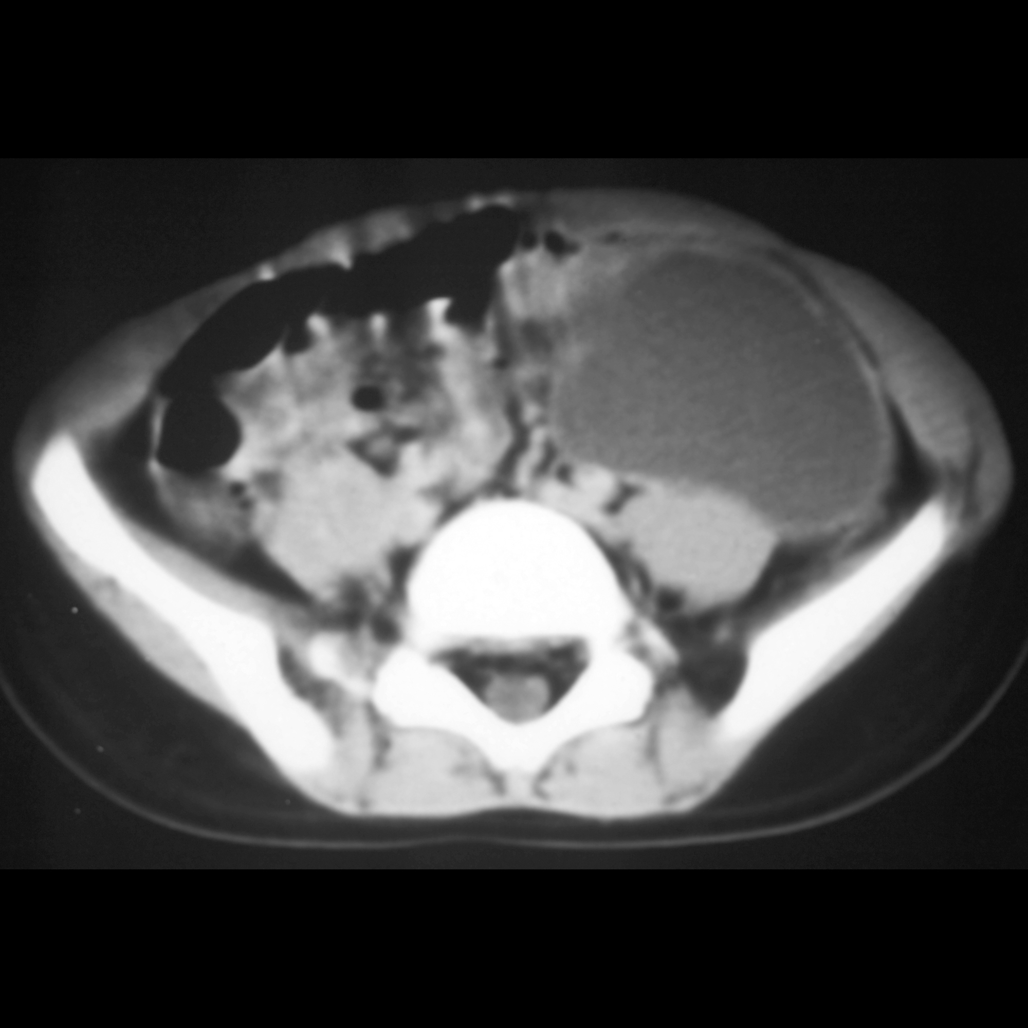 Pediatric Mesenteric Cyst | Pediatric Radiology Reference Article ...