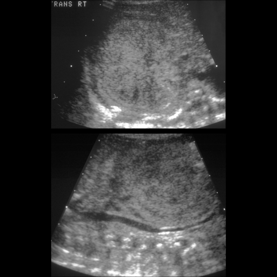 Mesoblastic Nephroma | Pediatric Radiology Reference Article ...