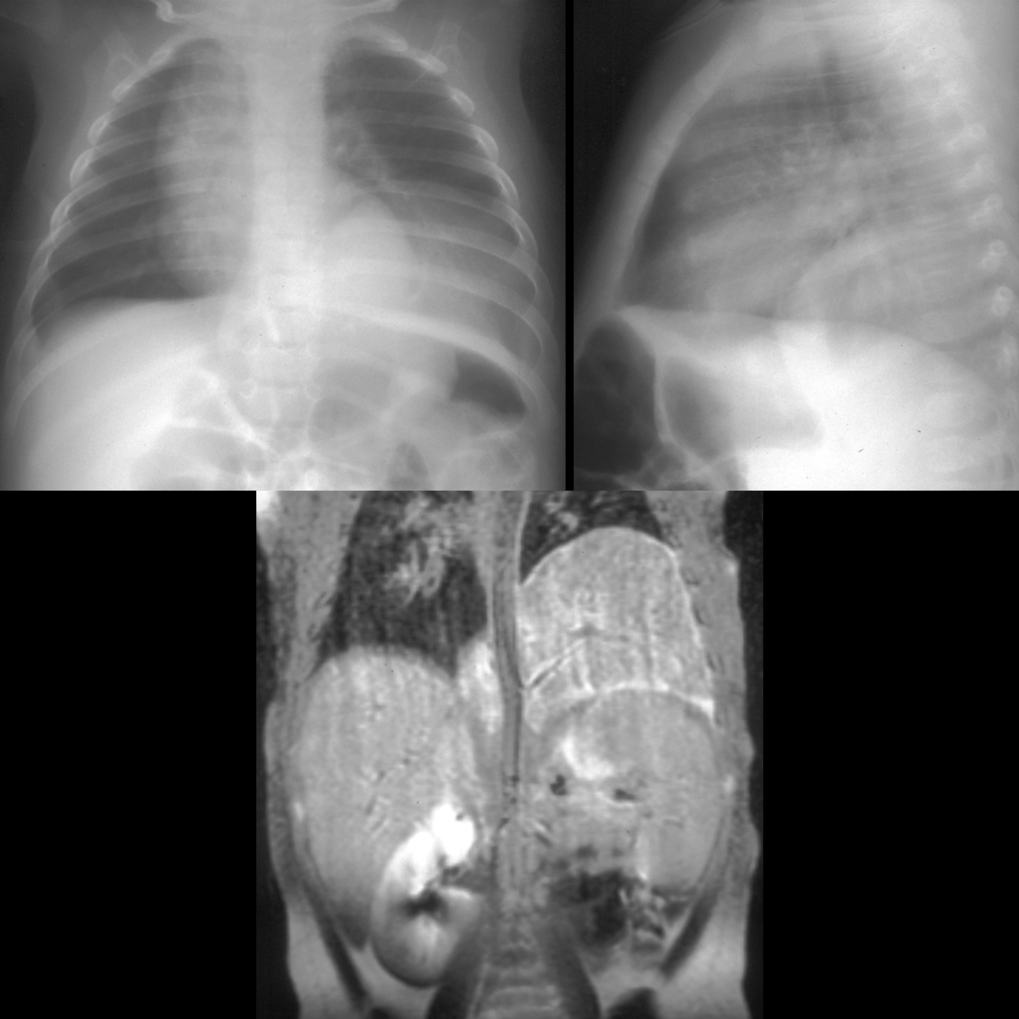 Pulmonary Sequestration | Pediatric Radiology Reference Article ...