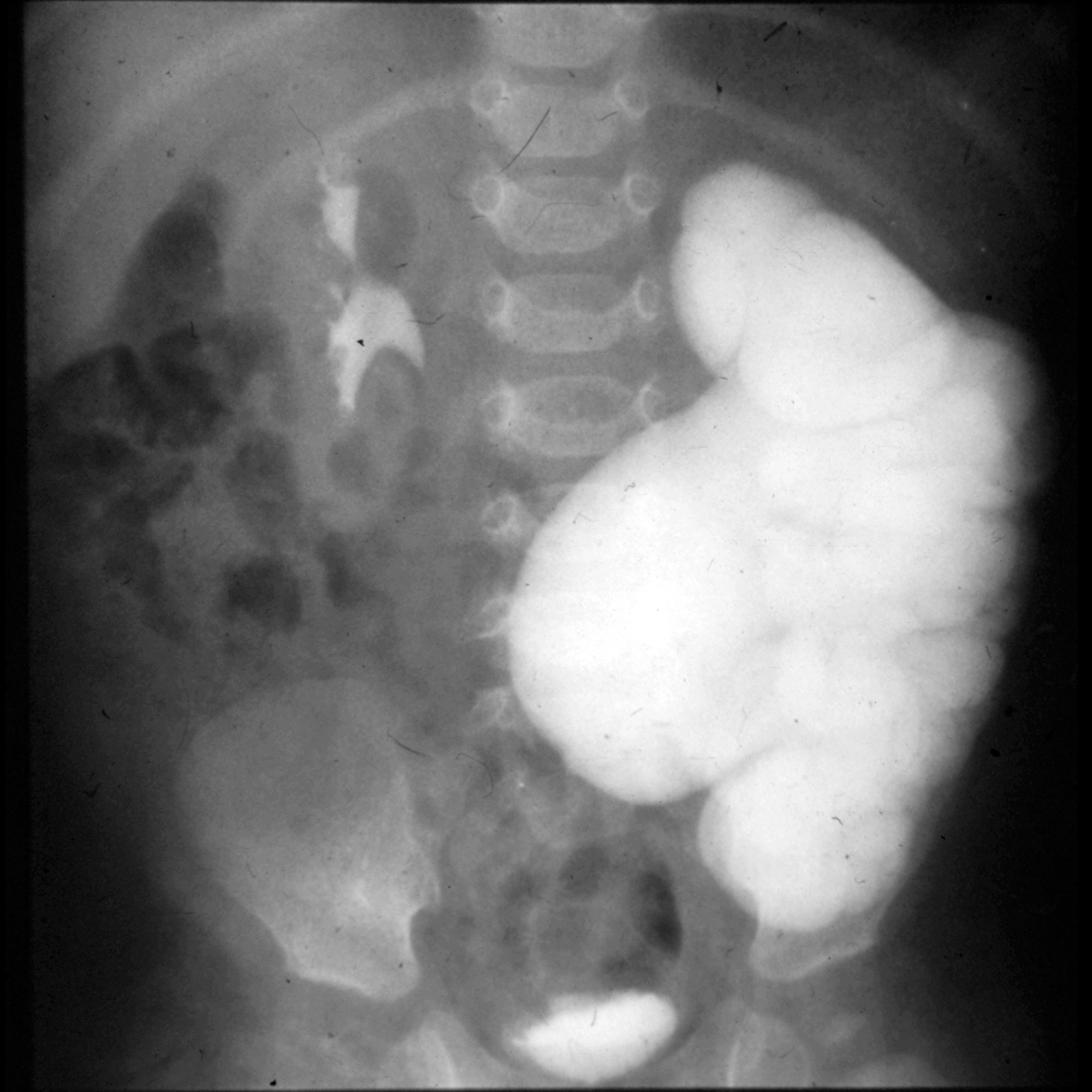 Pediatric Ureteropelvic Junction Obstruction | Pediatric Radiology ...