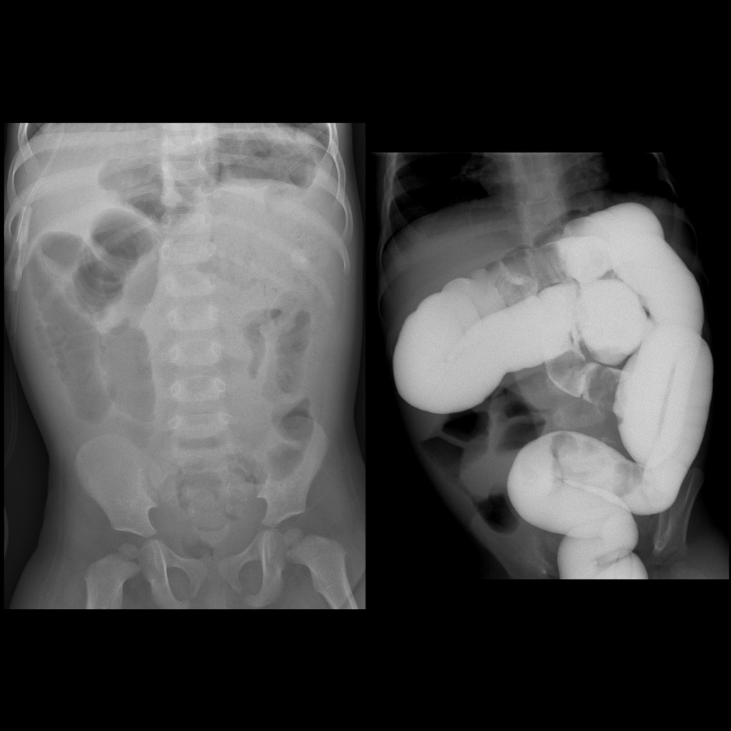 Distal Intestinal Obstruction Syndrome | Pediatric Radiology Reference ...