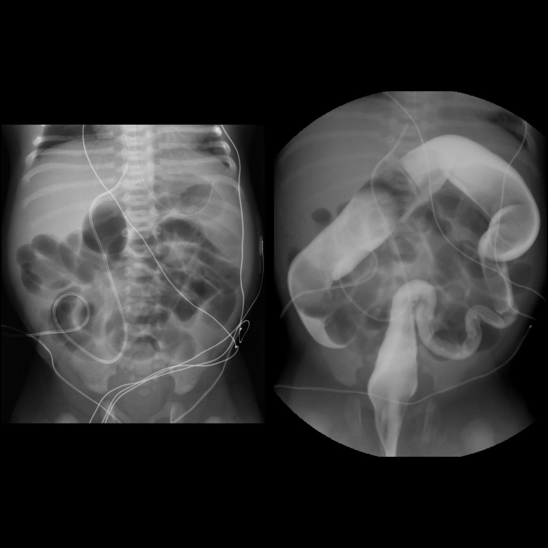 Meconium Plug Syndrome | Pediatric Radiology Reference Article ...
