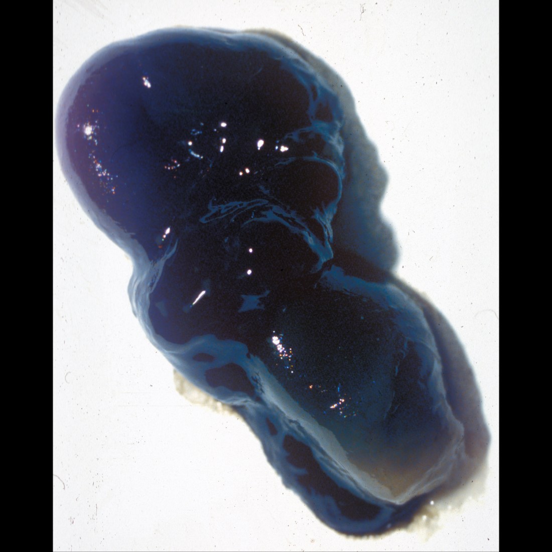 Meconium Plug Syndrome | Pediatric Radiology Reference Article ...