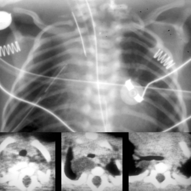 Pediatric Vertebral Body Anomalies | Pediatric Radiology Reference ...