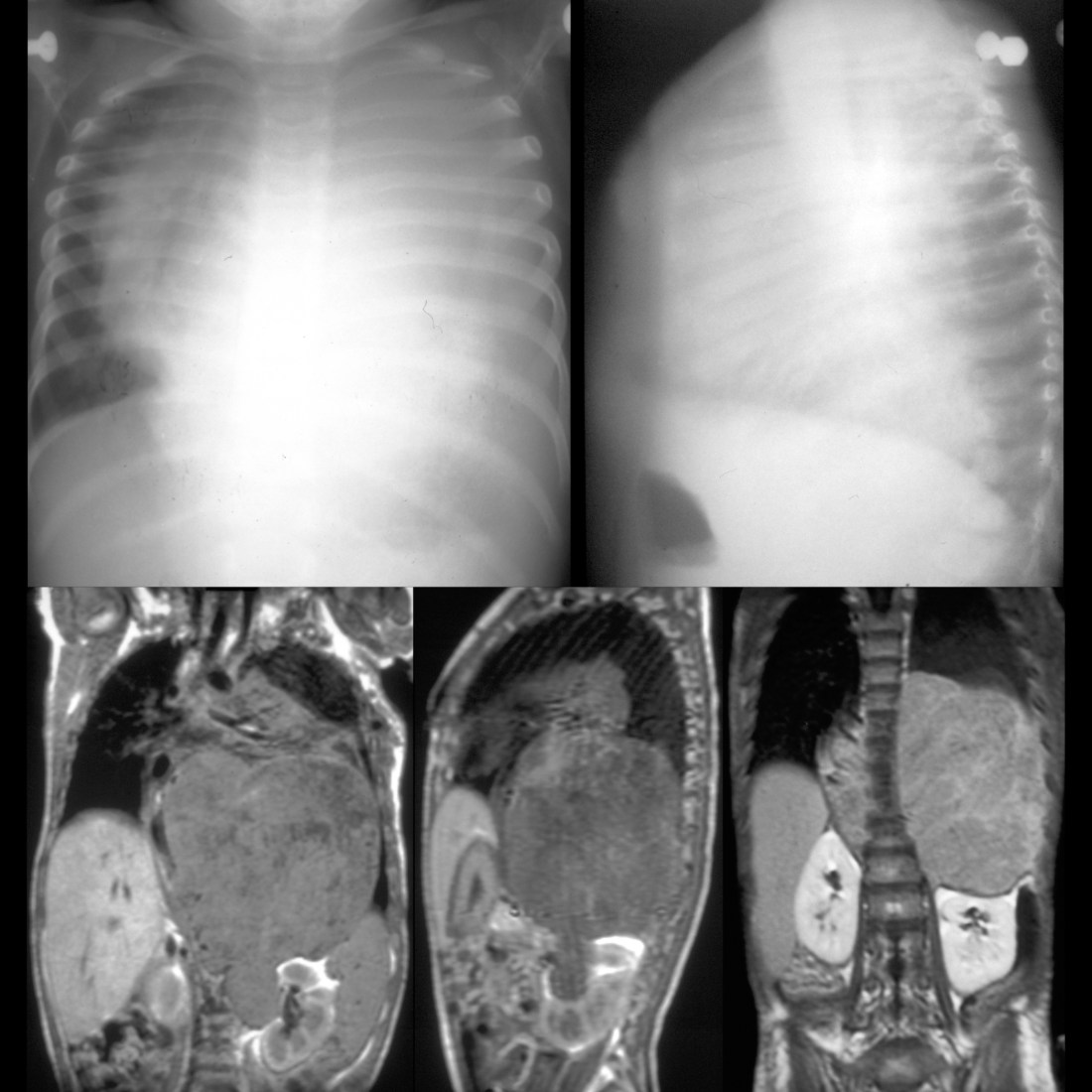 Neuroblastoma | Pediatric Radiology Reference Article | Pediatric ...