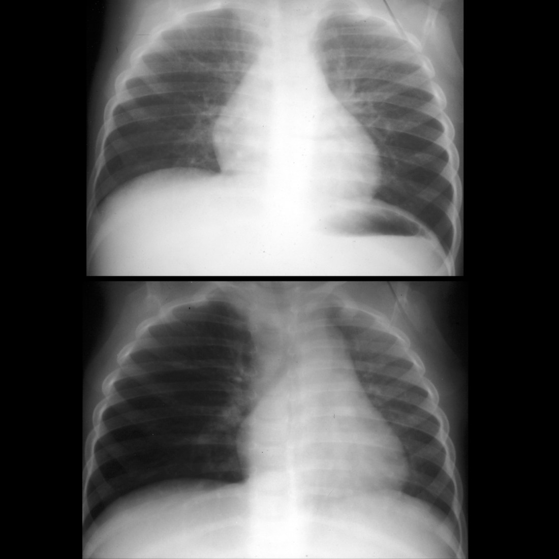Pediatric Airway Foreign Body | Pediatric Radiology Reference Article ...