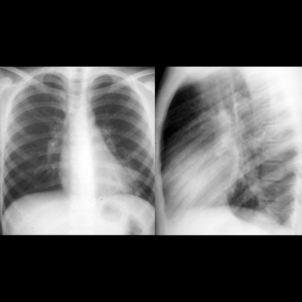 Pediatric Bronchiectasis | Pediatric Radiology Reference Article ...