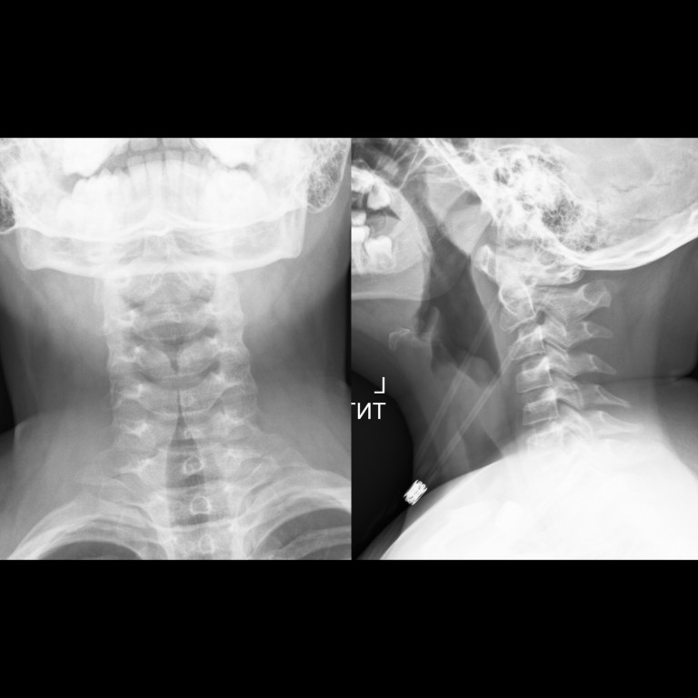Croup | Pediatric Radiology Reference Article | Pediatric Imaging ...