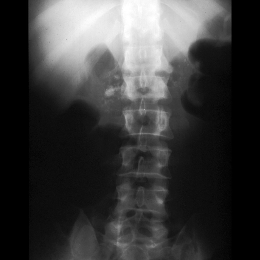 Pediatric Cystic Fibrosis Pancreas | Pediatric Radiology Reference ...