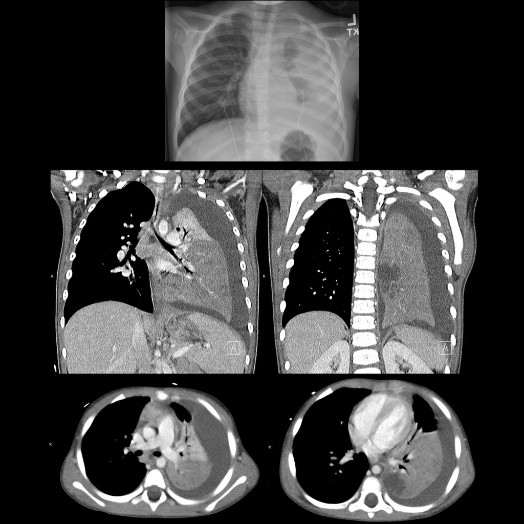 Pediatric Necrotizing Pneumonia | Pediatric Radiology Reference Article ...