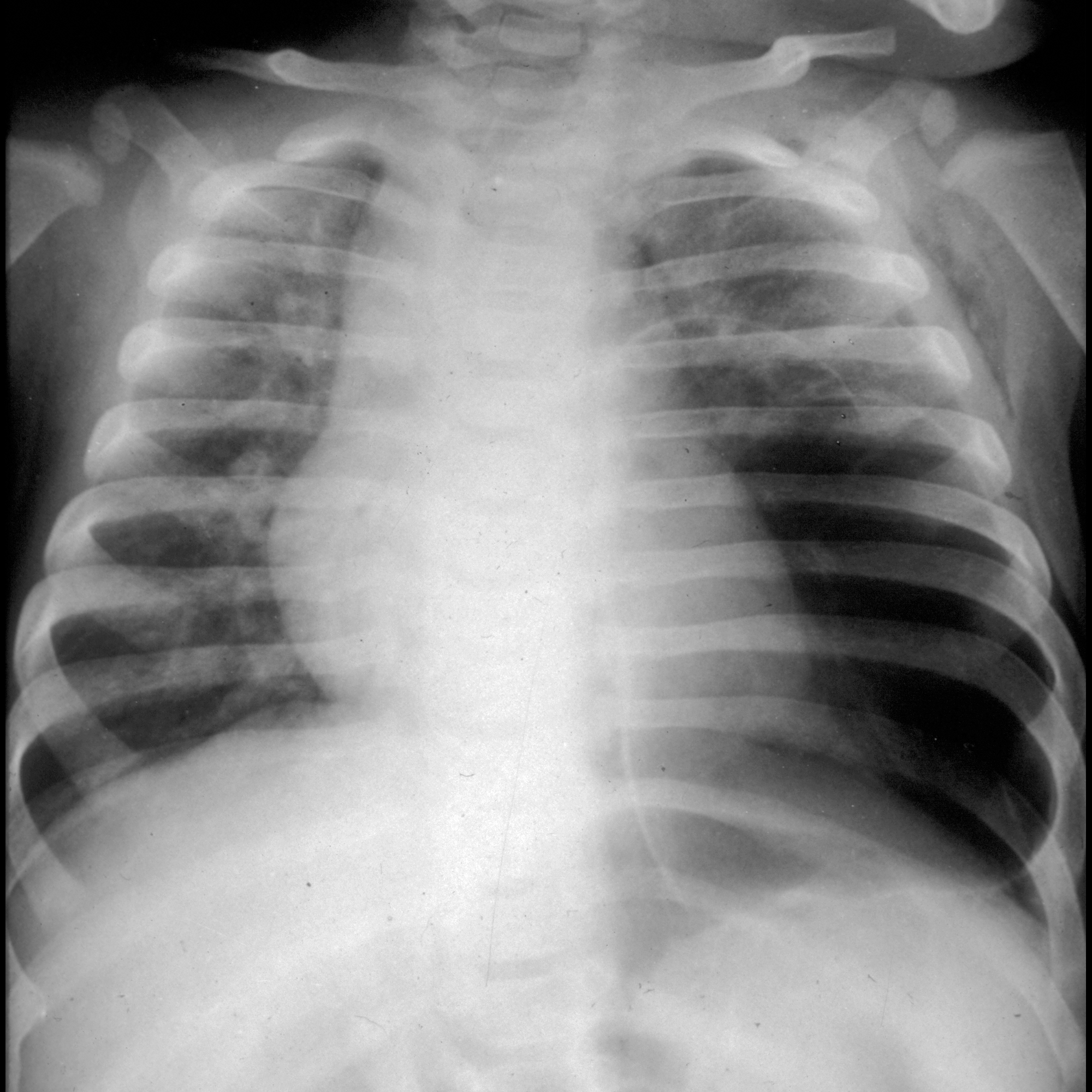 Pediatric Pneumatocele | Pediatric Radiology Reference Article ...