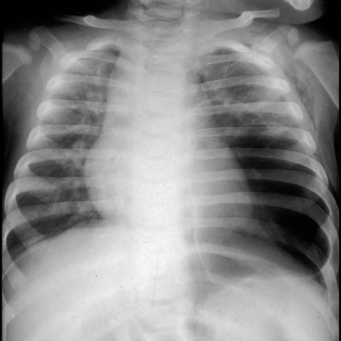 Pediatric Staphylococcus Pneumonia | Pediatric Radiology Reference ...