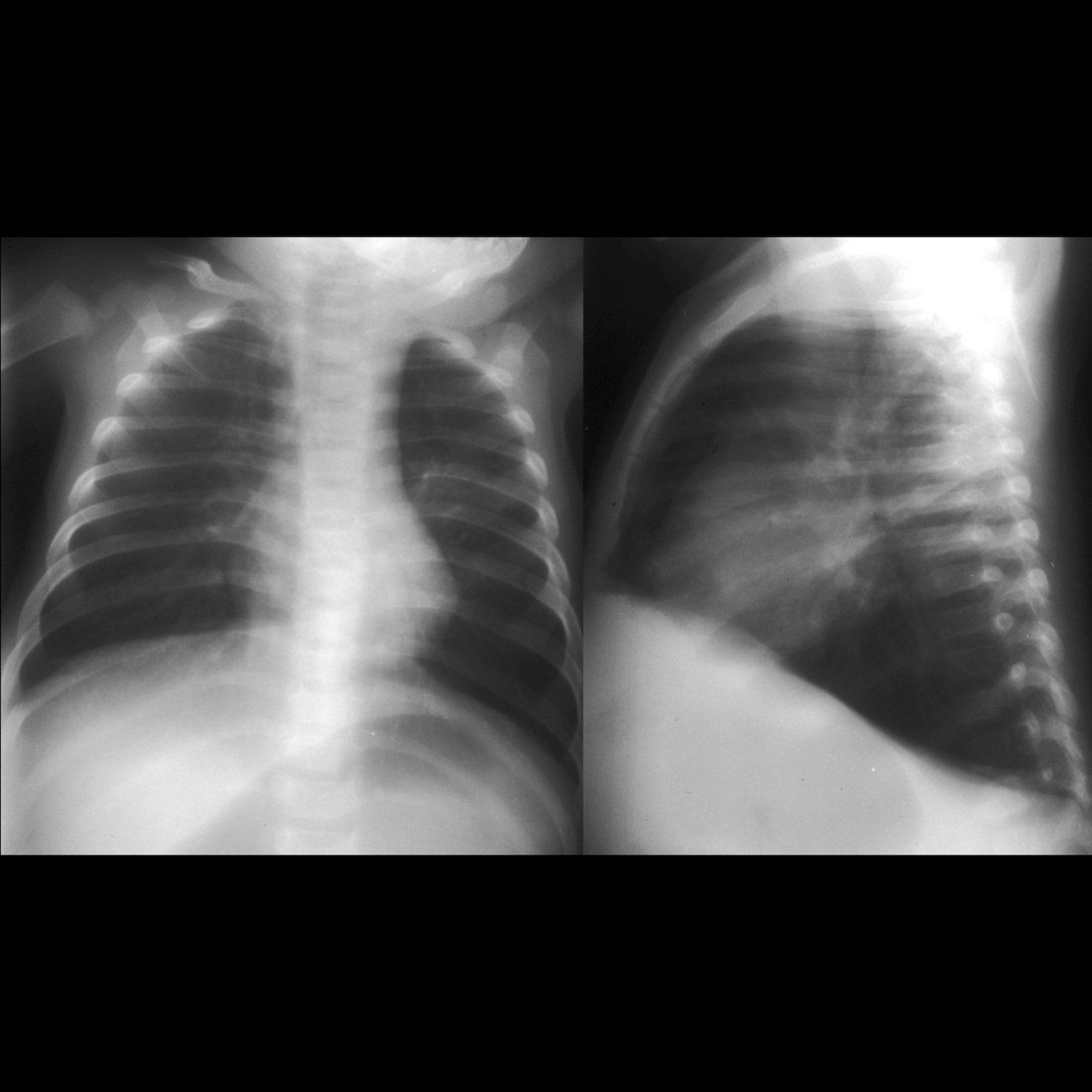 Pediatric Viral Pneumonia | Pediatric Radiology Reference Article ...