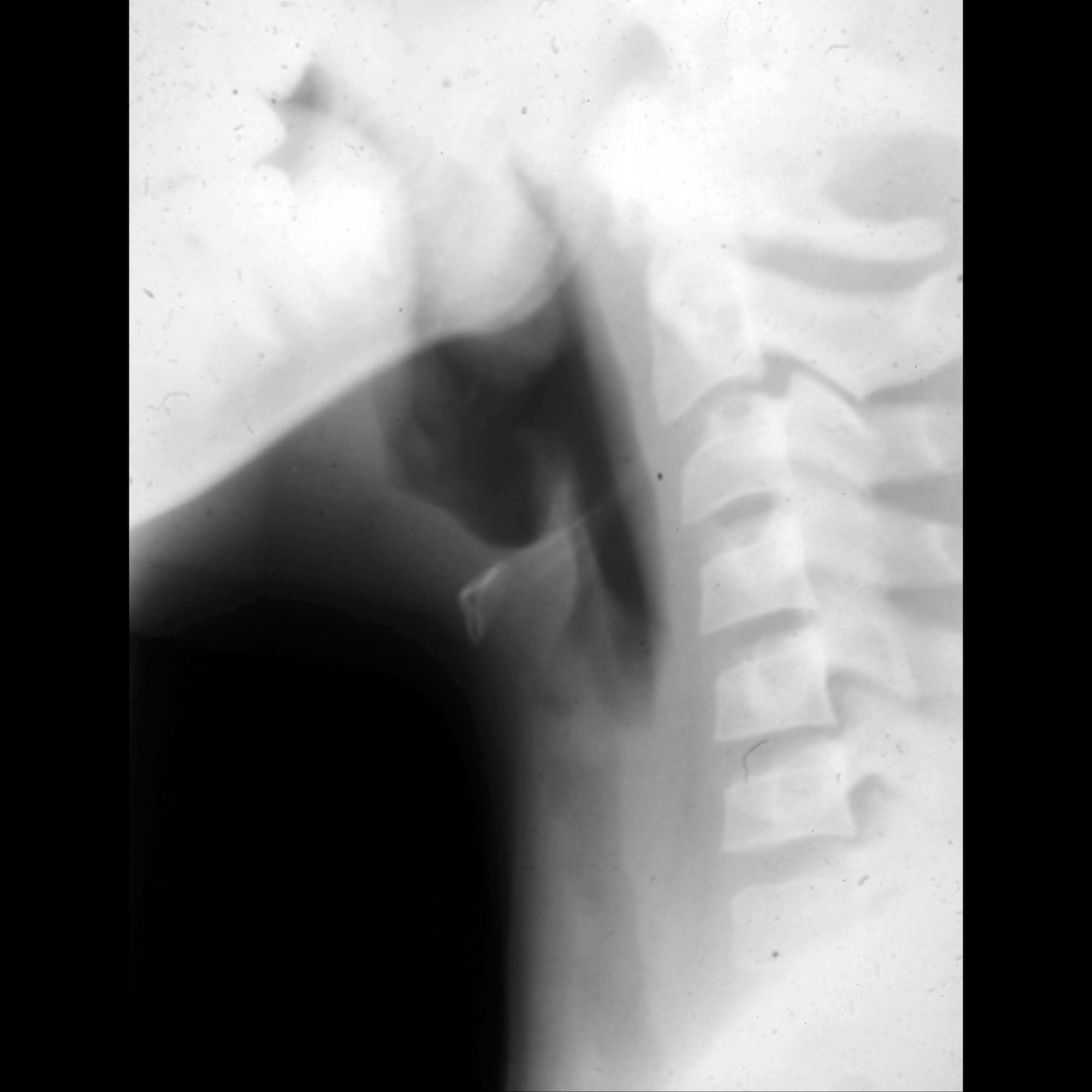 Bacterial Tracheitis | Pediatric Radiology Reference Article ...