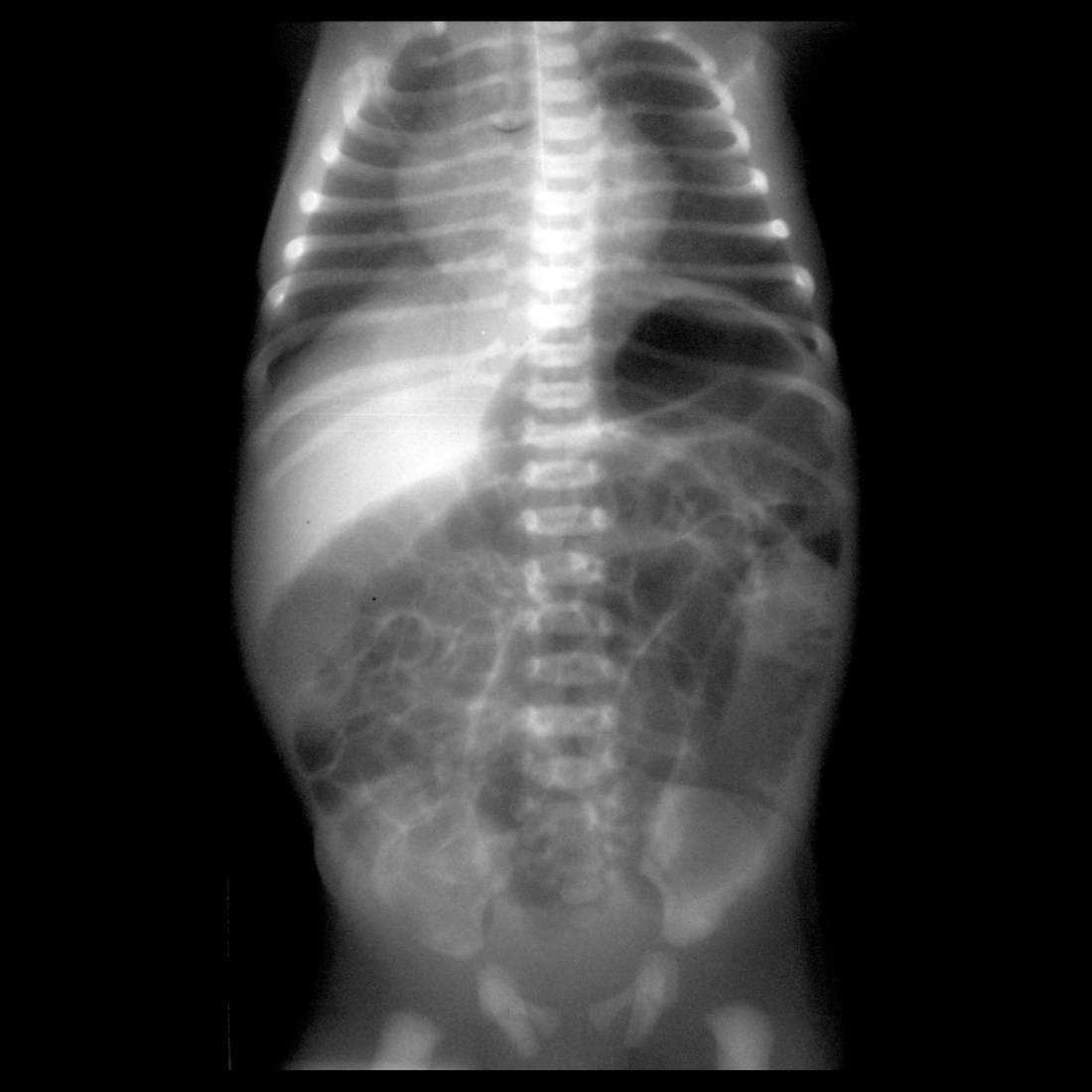 Anorectal Malformation | Pediatric Radiology Reference Article ...
