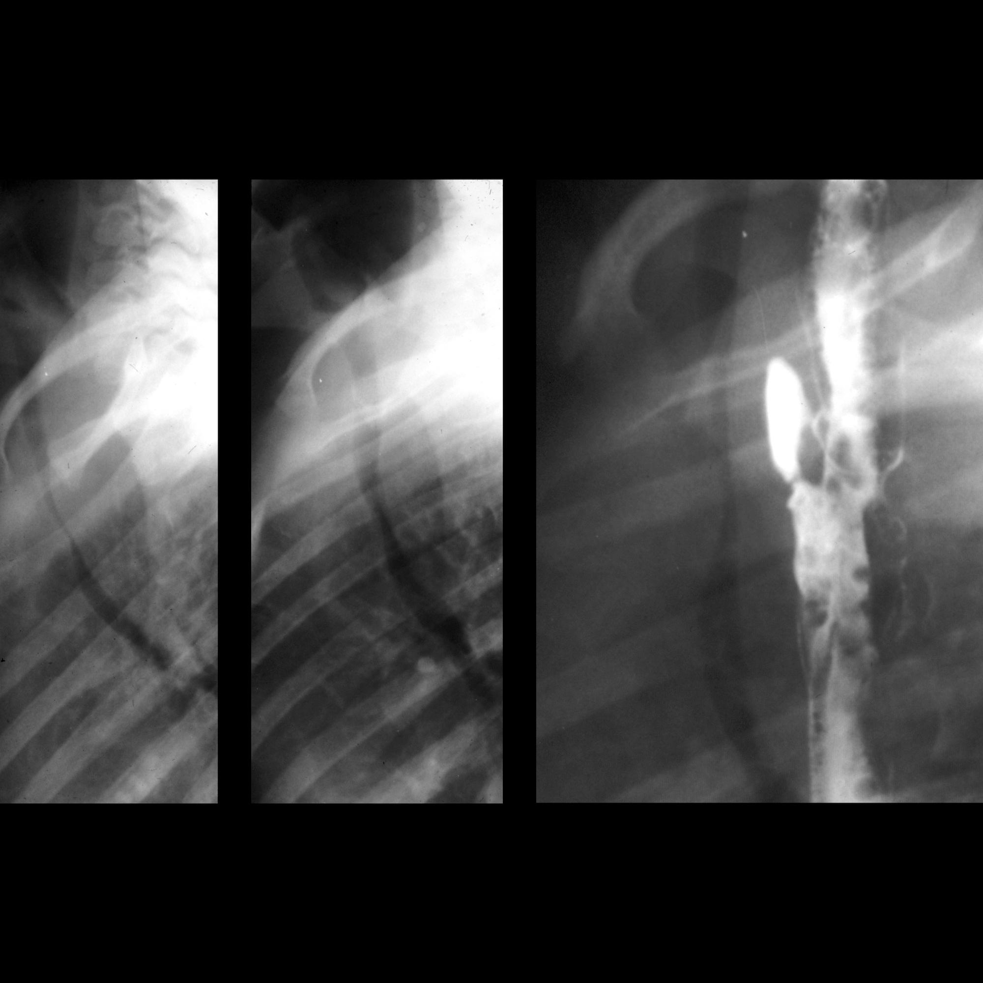 Pediatric Retropharyngeal Abscess | Pediatric Radiology Reference ...