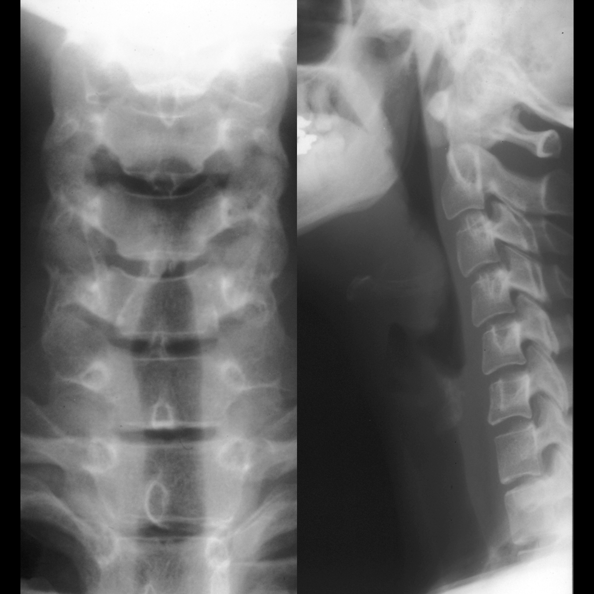 Pediatric Lingual Tonsillar Hypertrophy | Pediatric Radiology Reference ...