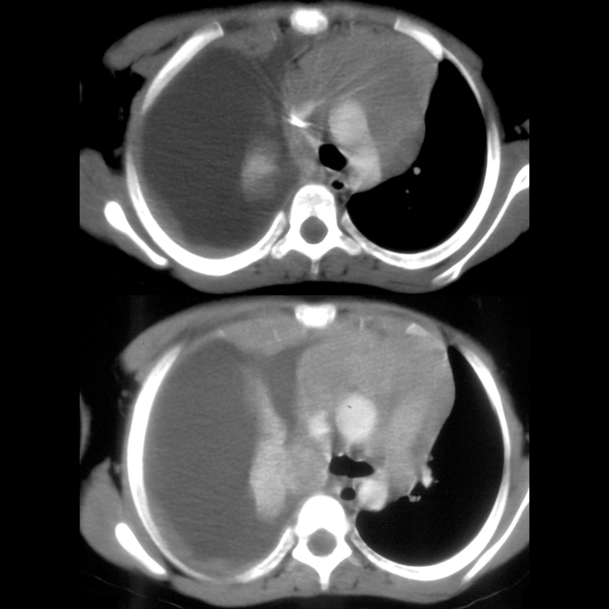 Pediatric Non-Hodgkin Lymphoma | Pediatric Radiology Reference Article ...
