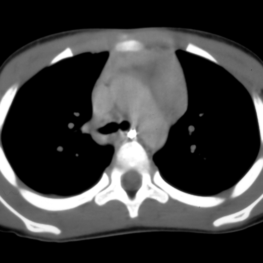 Prominent Thymus | Pediatric Radiology Reference Article | Pediatric ...