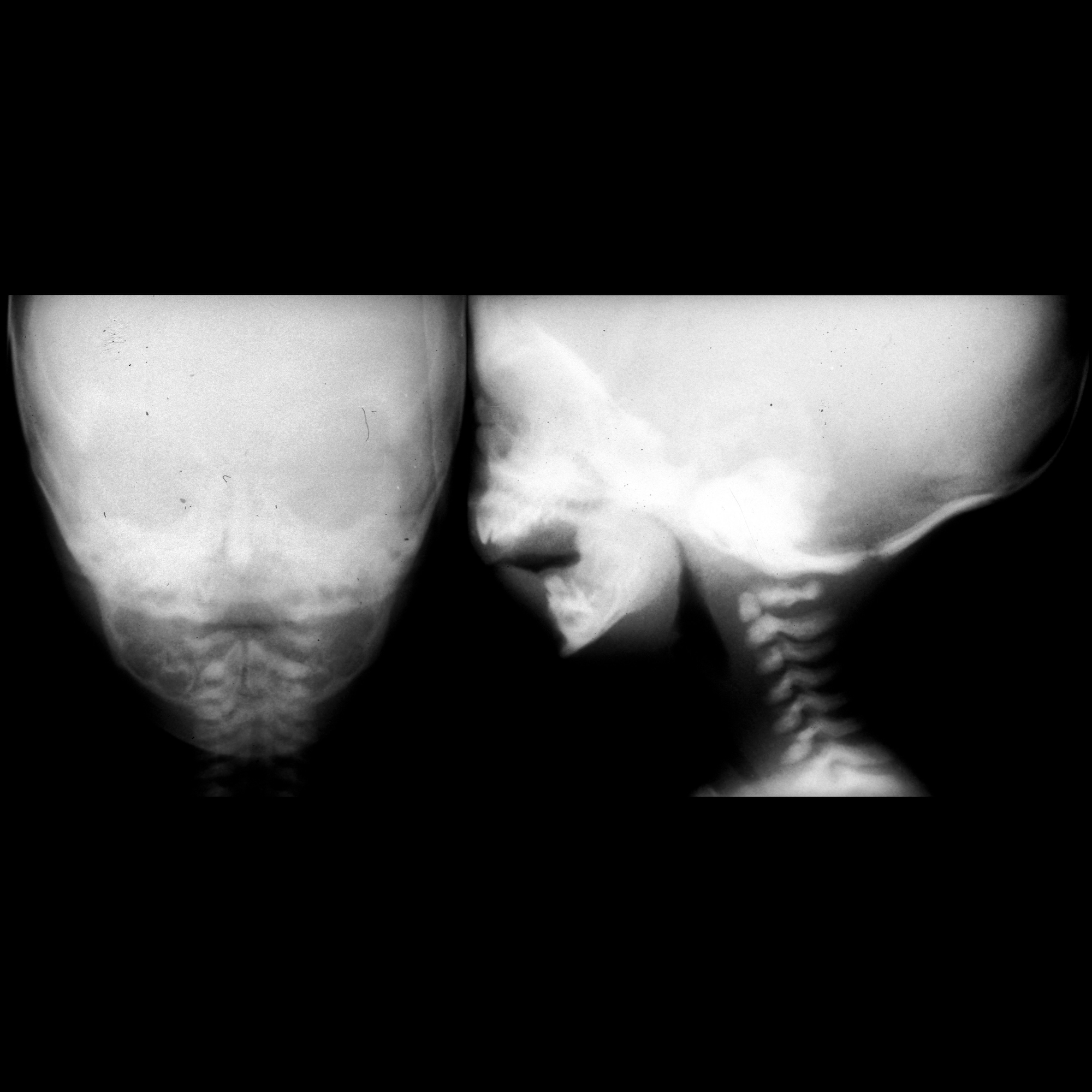 Pierre Robin Syndrome | Pediatric Radiology Reference Article ...