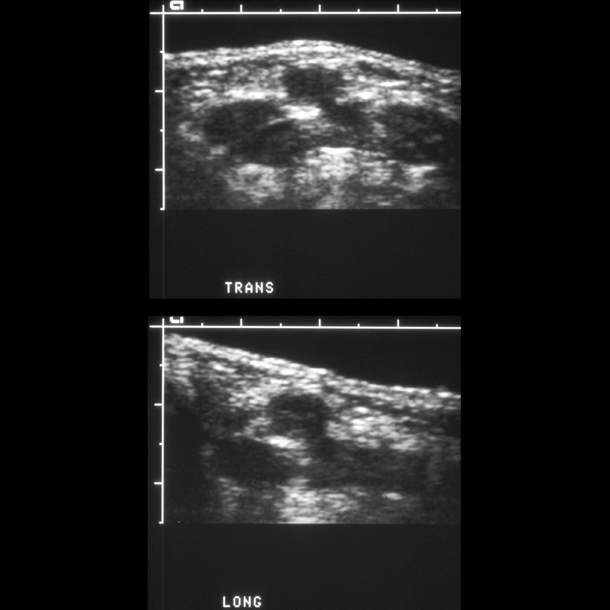 Thyroglossal Duct Cyst Ultrasound Thyroglossal Duct Cyst Radiology
