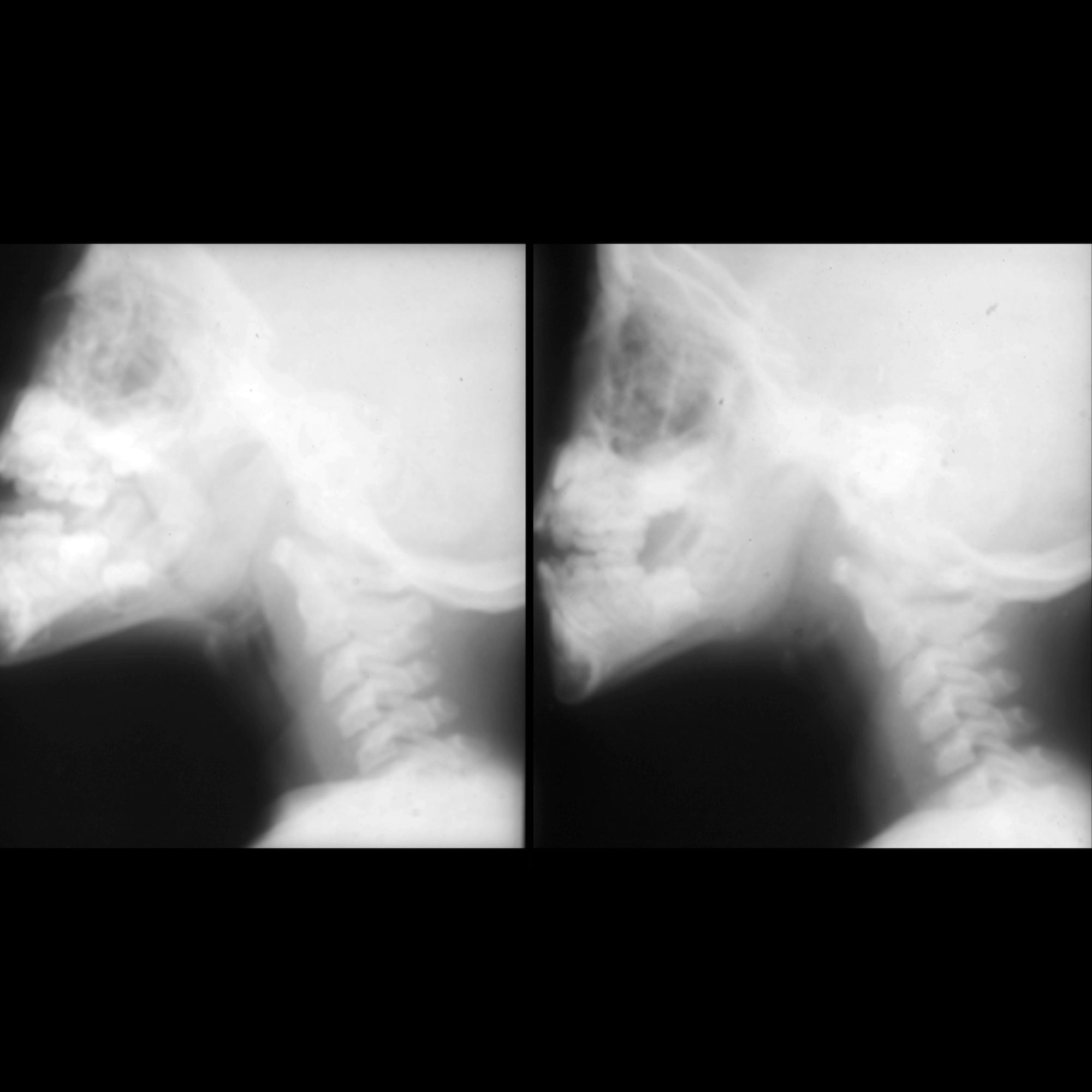 Pediatric Adenoid Tonsillar Hypertrophy | Pediatric Radiology Reference ...