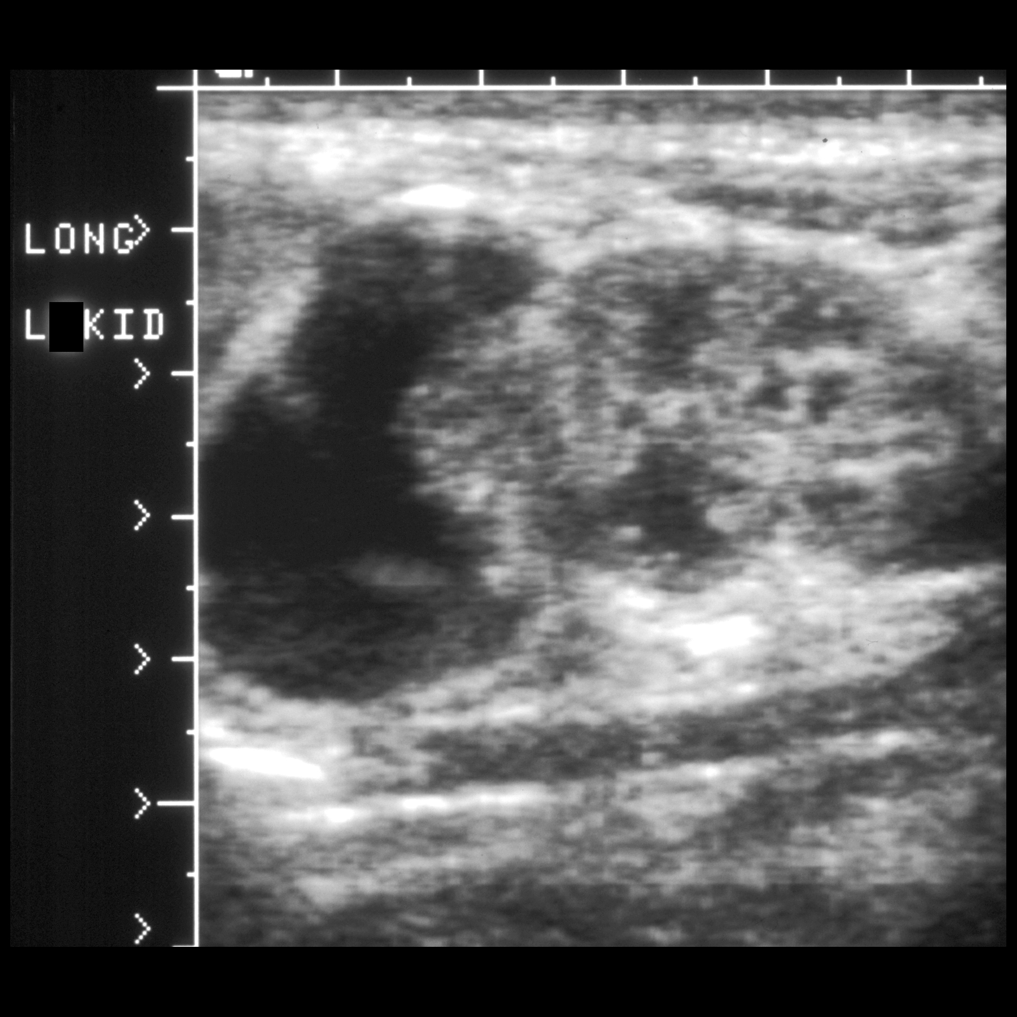 Newborn with a left upper quadrant mass | Pediatric Radiology Case ...