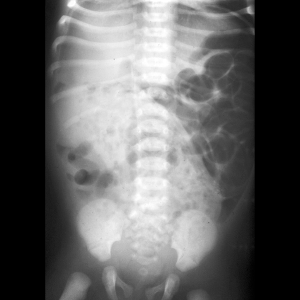 Pediatric Small Bowel Perforation | Pediatric Radiology Reference ...