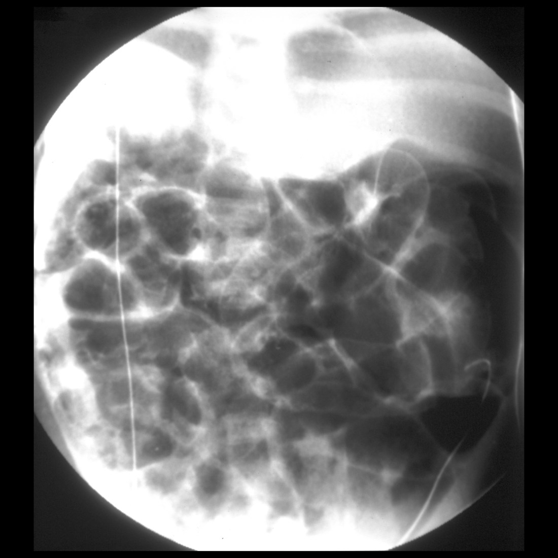 Ileocolic Intussusception | Pediatric Radiology Reference Article ...