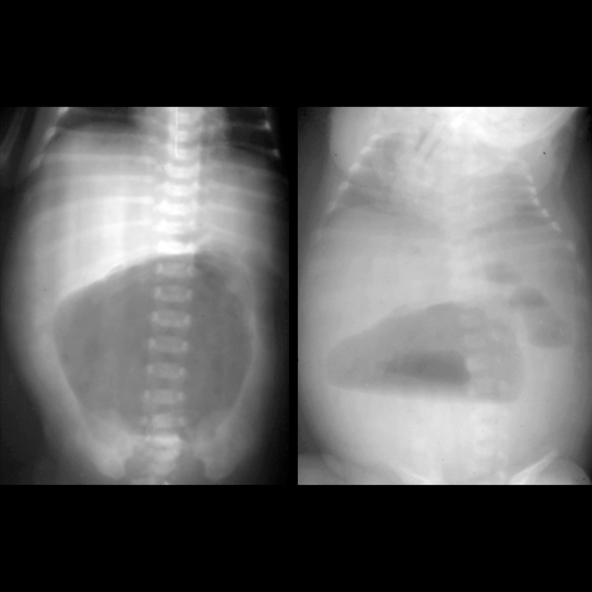 Pediatric Small Bowel Perforation | Pediatric Radiology Reference ...