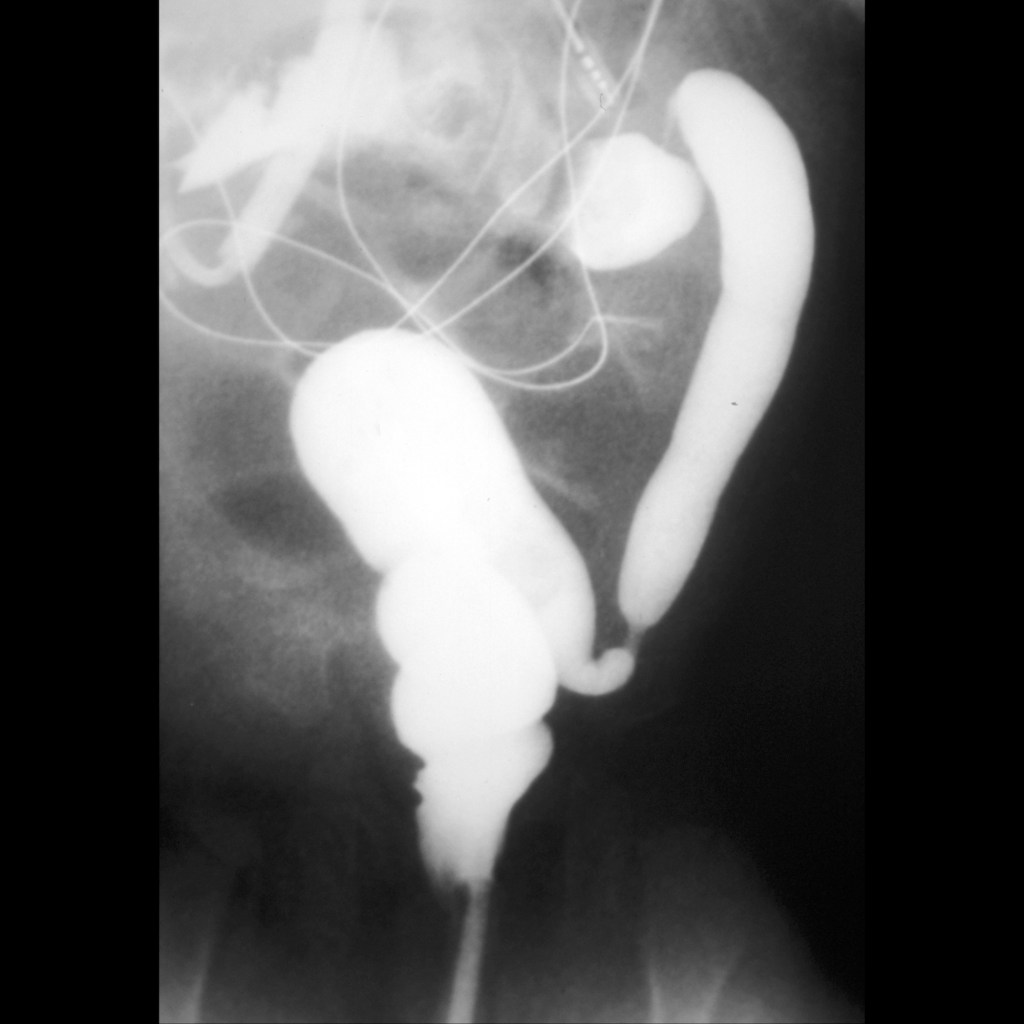 Necrotizing Enterocolitis | Pediatric Radiology Reference Article ...