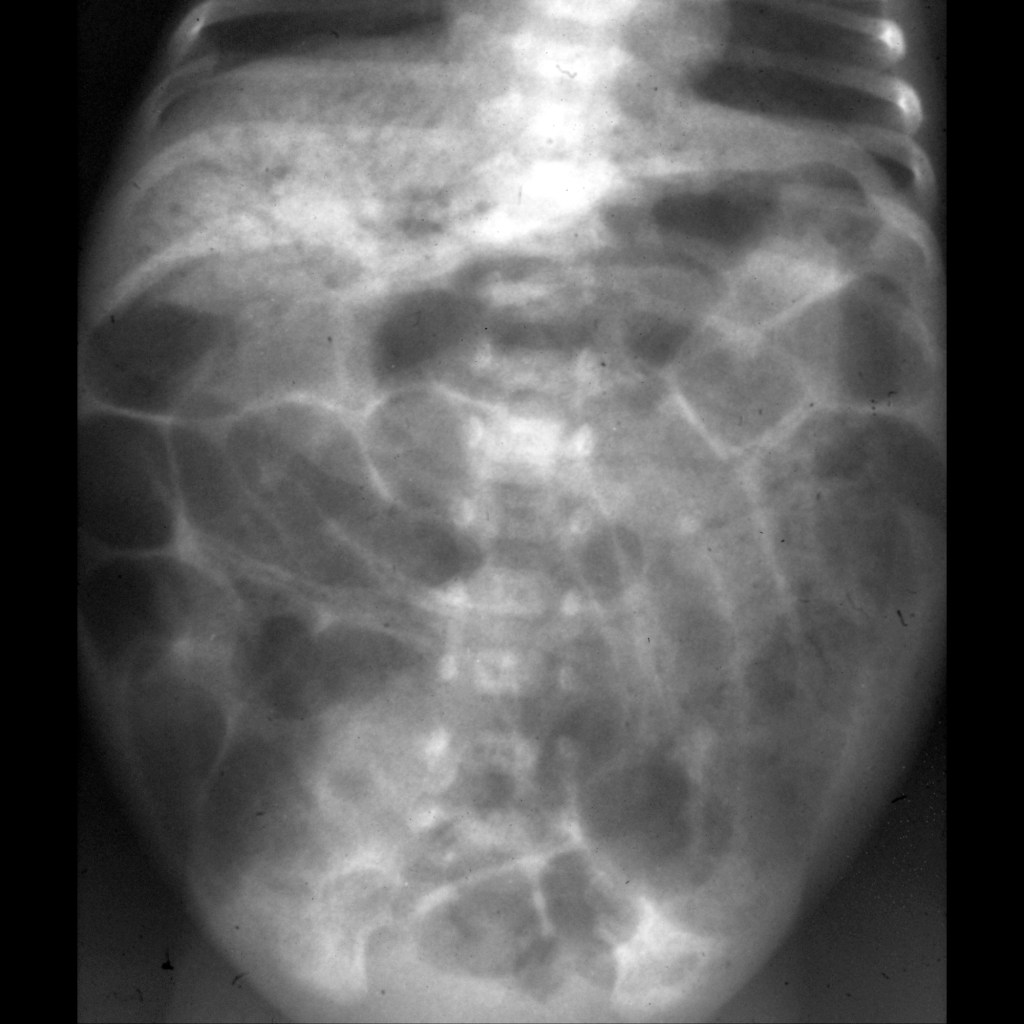 Necrotizing Enterocolitis | Pediatric Radiology Reference Article ...
