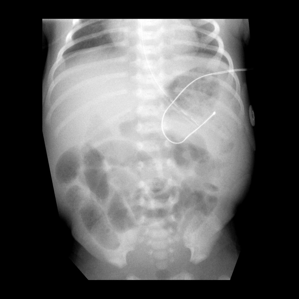 Necrotizing Enterocolitis | Pediatric Radiology Reference Article ...