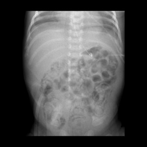 Pediatric Pneumatosis Intestinalis | Pediatric Radiology Reference ...
