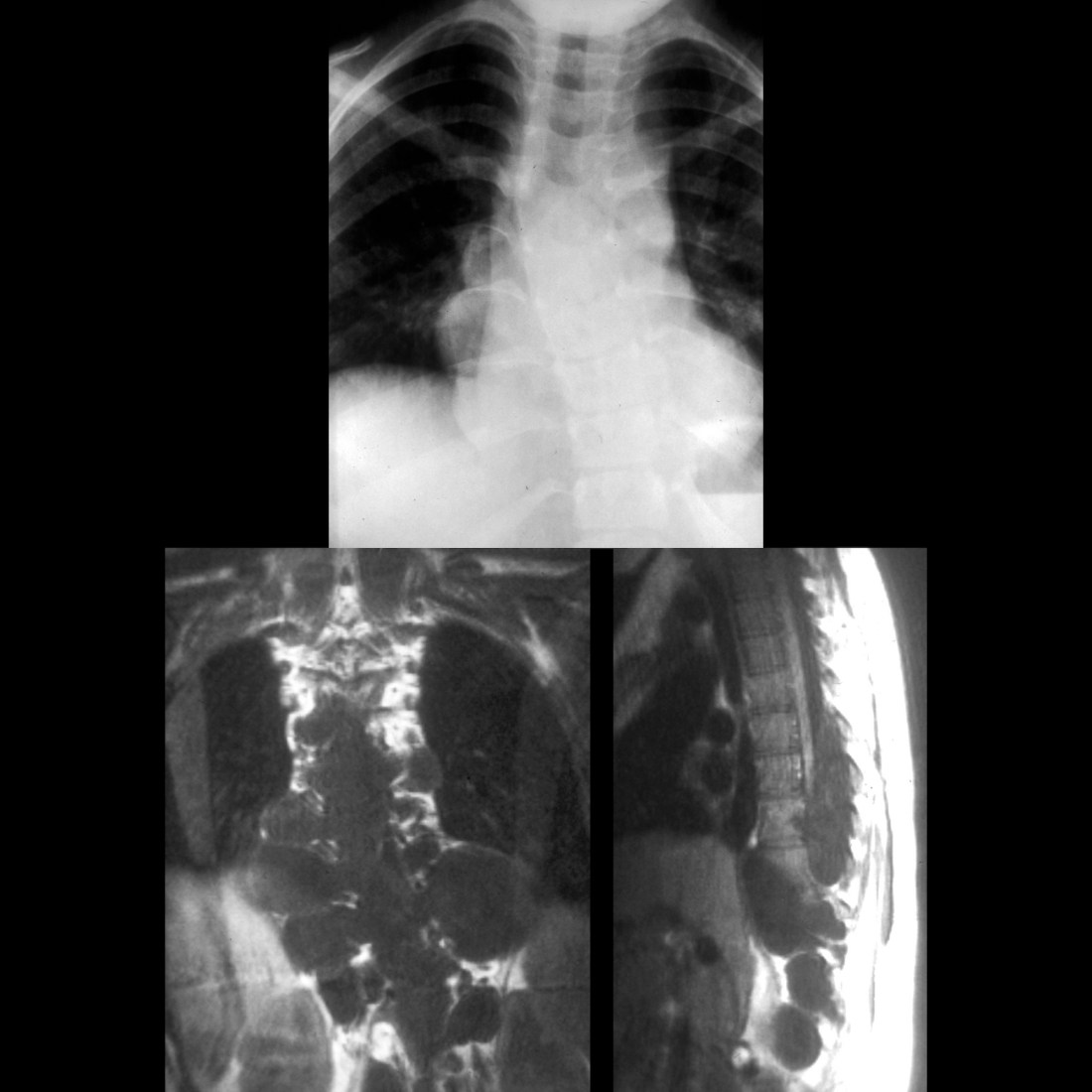 Pediatric Plexiform Neurofibroma | Pediatric Radiology Reference ...