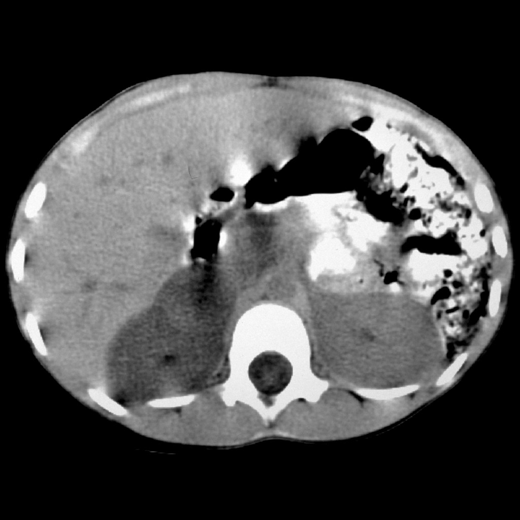 Pediatric Pheochromocytoma | Pediatric Radiology Reference Article ...