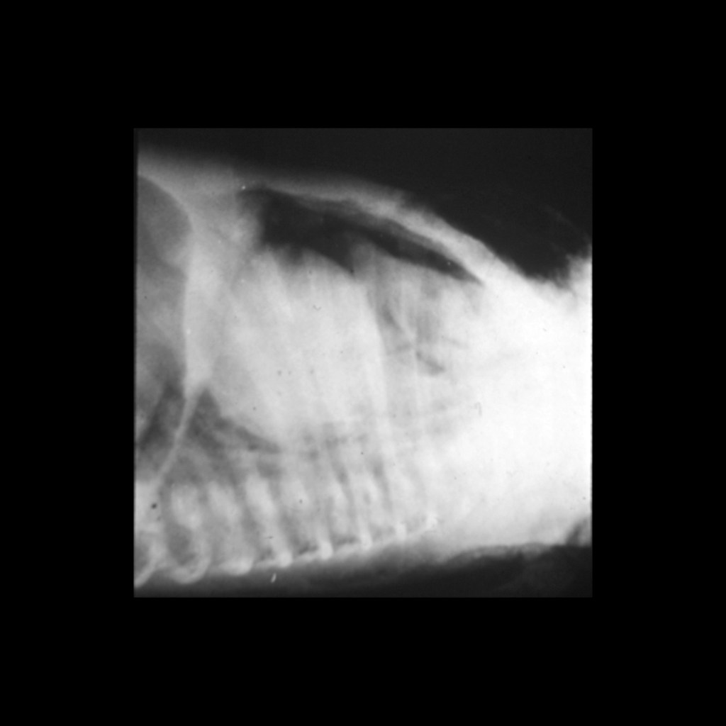 Pediatric Pneumothorax | Pediatric Radiology Reference Article ...