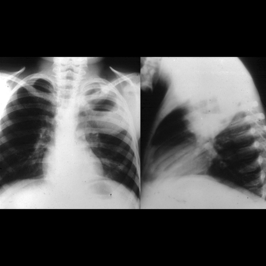 Pediatric Staphylococcus Pneumonia | Pediatric Radiology Reference ...