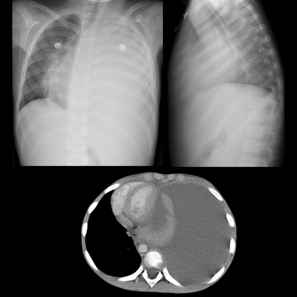 Pediatric Pleural Empyema | Pediatric Radiology Reference Article ...