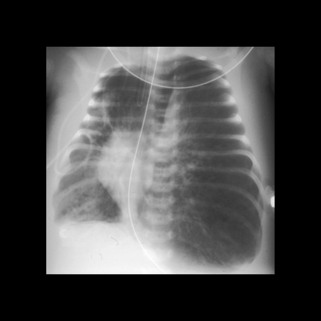 Swyer James Syndrome | Pediatric Radiology Reference Article ...